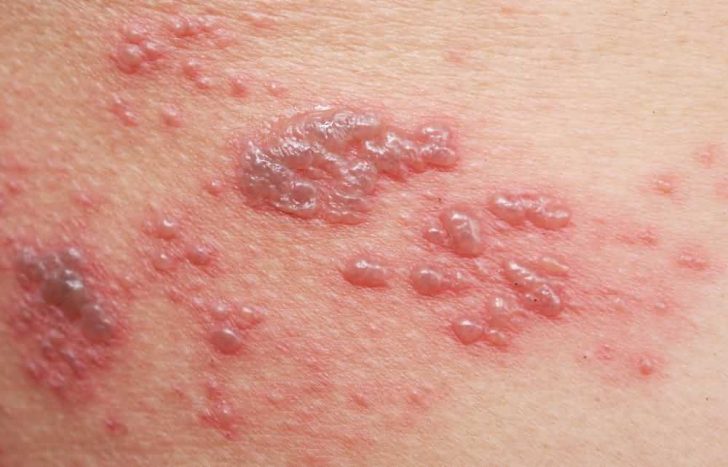 Herpes Simplex Virus (HSV); Signs, Symptoms & Treatment
