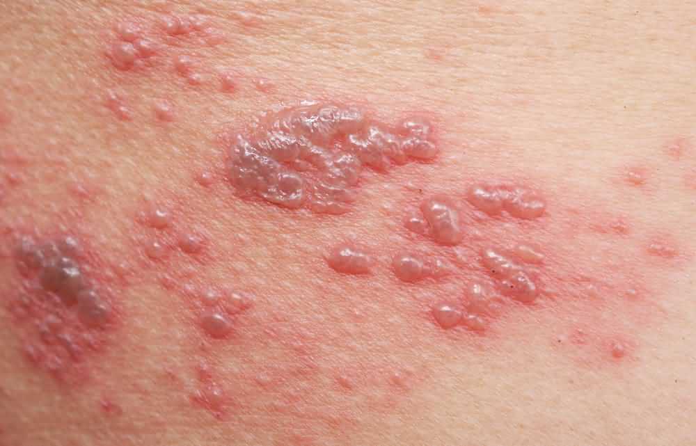 Herpes Simplex Virus (HSV); Signs, Symptoms & Treatment